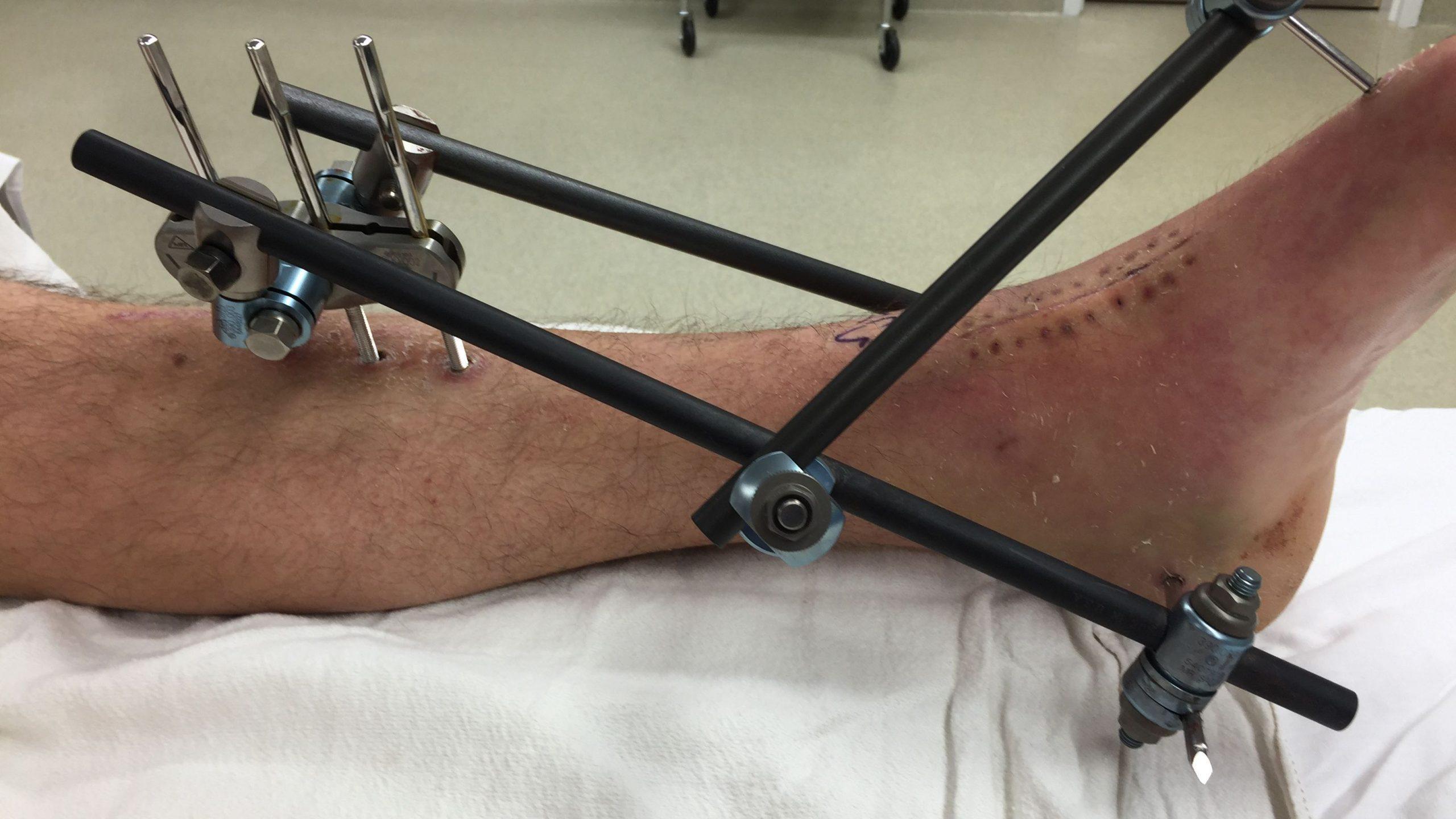 Ortho House’s External Fixators - Ortho House