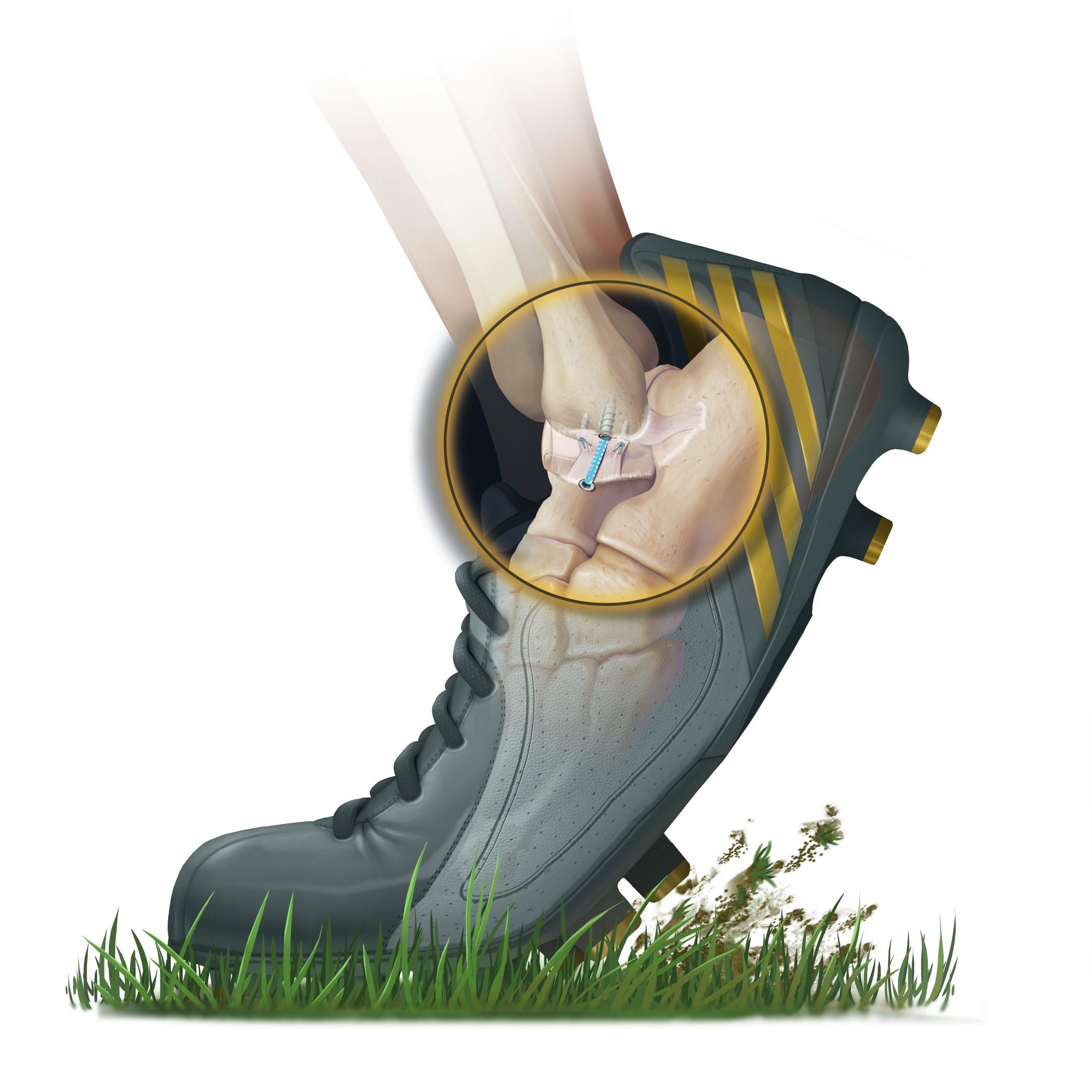 InternalBrace™ - Ortho House