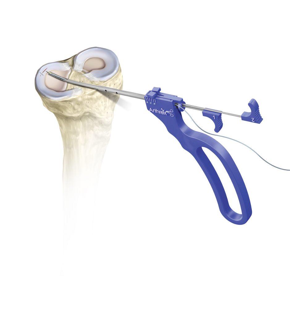 Meniscal Cinch™ - Ortho House