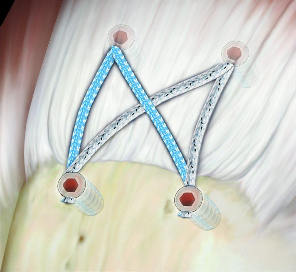 SpeedBridge™ Repair - Ortho House