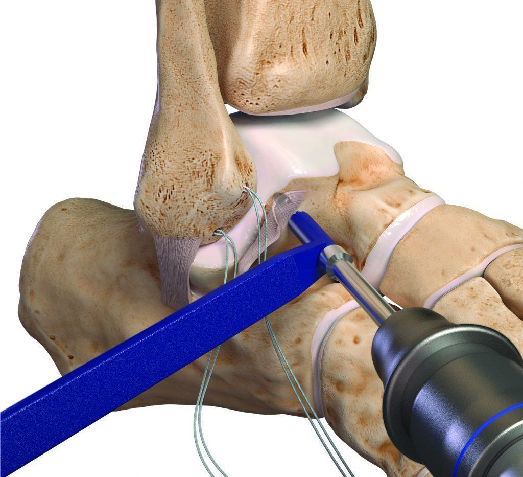 InternalBrace™ - Ortho House