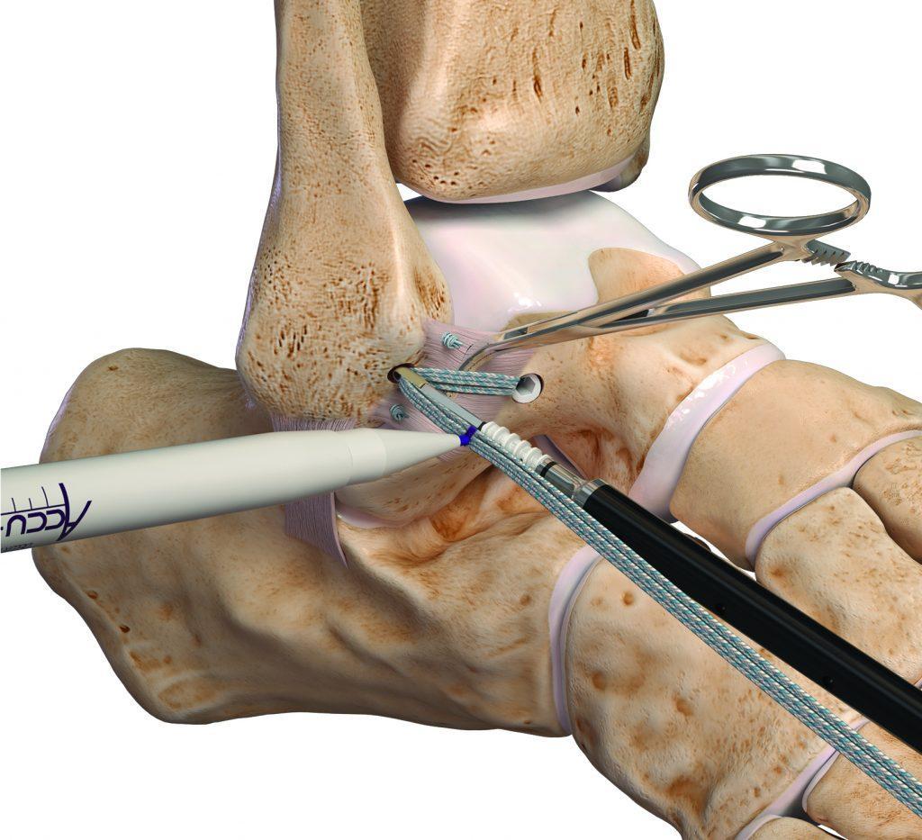 InternalBrace™ - Ortho House