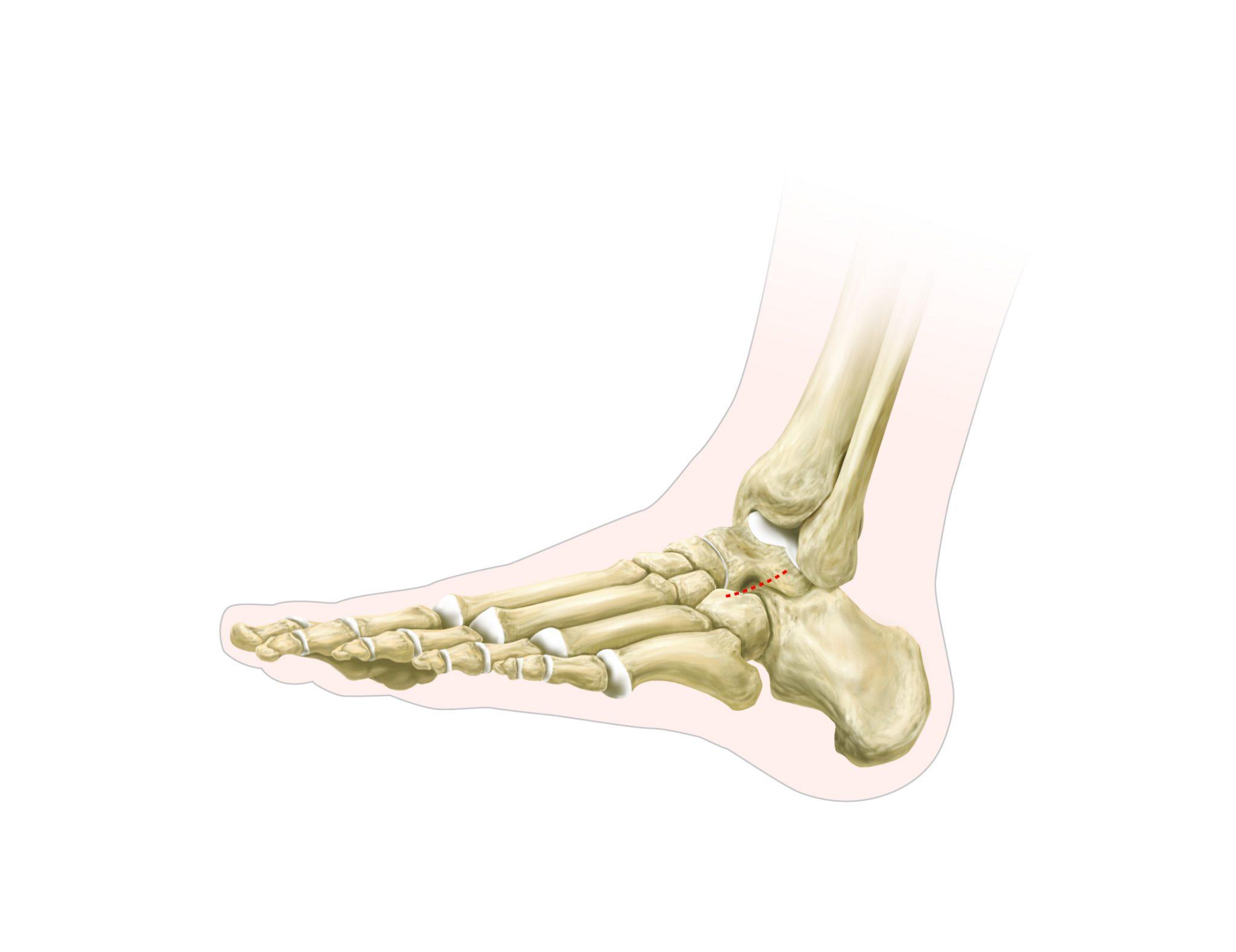 AR-4209-14 ProStop™ Subtalar Arthroereisis Implant, 9 x 14 mm - Ortho House