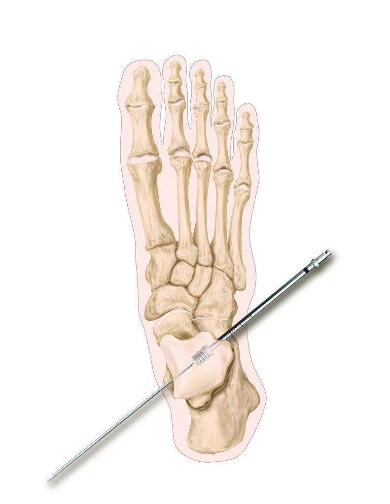 AR-4209-14 ProStop™ Subtalar Arthroereisis Implant, 9 x 14 mm - Ortho House