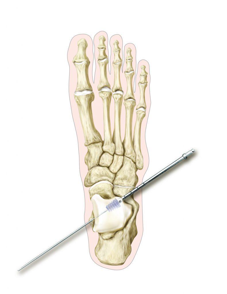 AR-4209-14 ProStop™ Subtalar Arthroereisis Implant, 9 x 14 mm - Ortho House