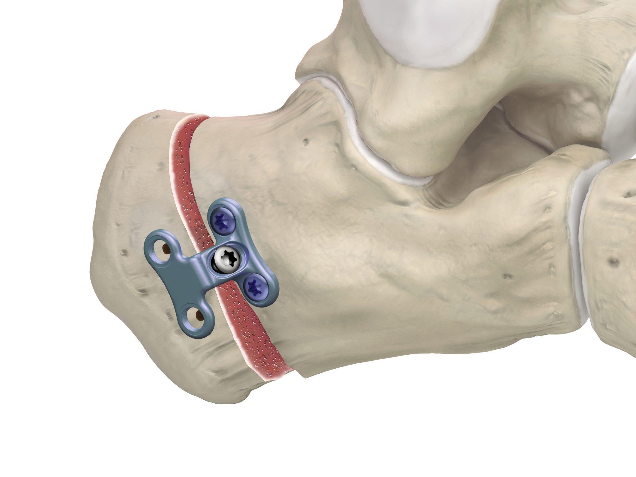 LT2-0494-EN Calcaneus Step Plate - Ortho House