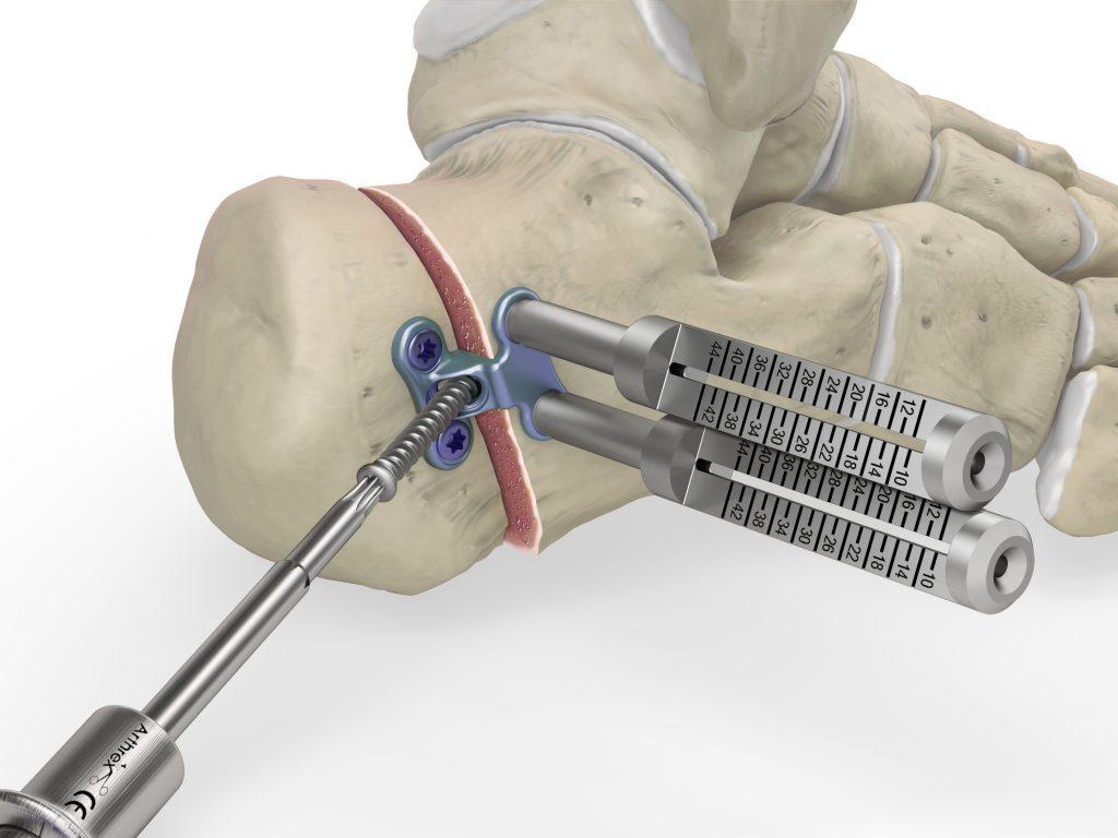 LT2-0494-EN Calcaneus Step Plate - Ortho House