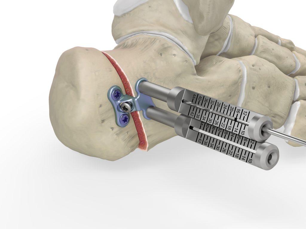 LT2-0494-EN Calcaneus Step Plate - Ortho House