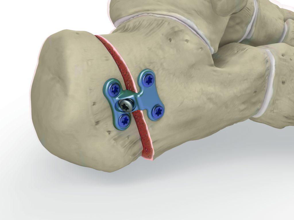 LT2-0494-EN Calcaneus Step Plate - Ortho House