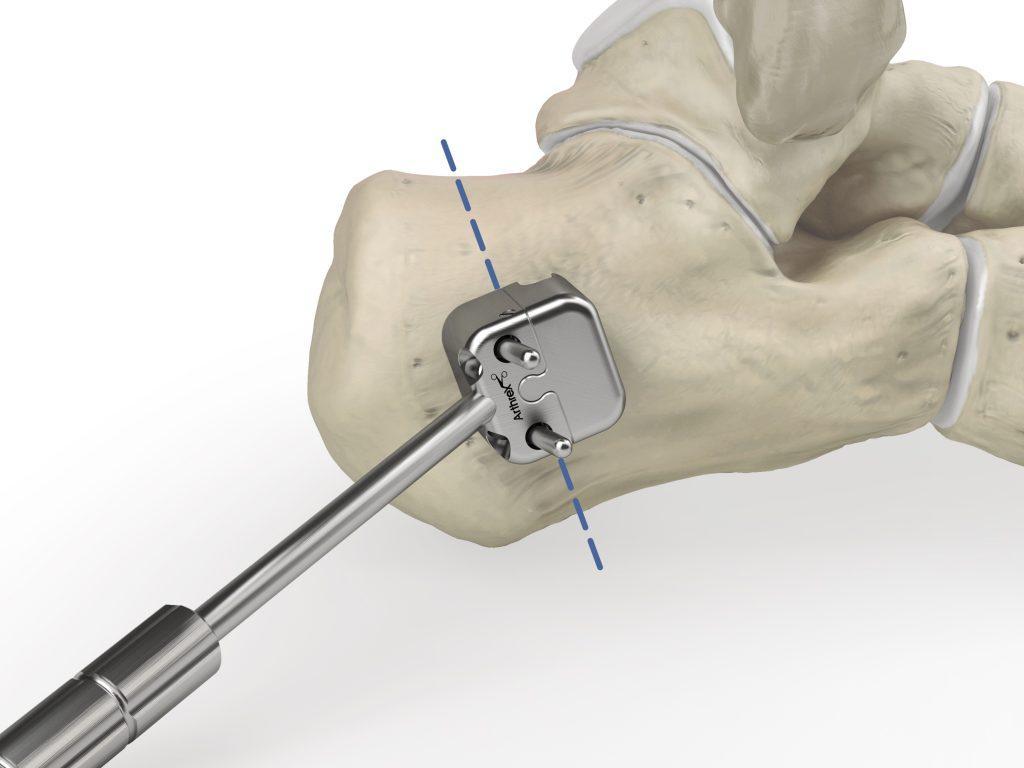 LT2-0494-EN Calcaneus Step Plate - Ortho House